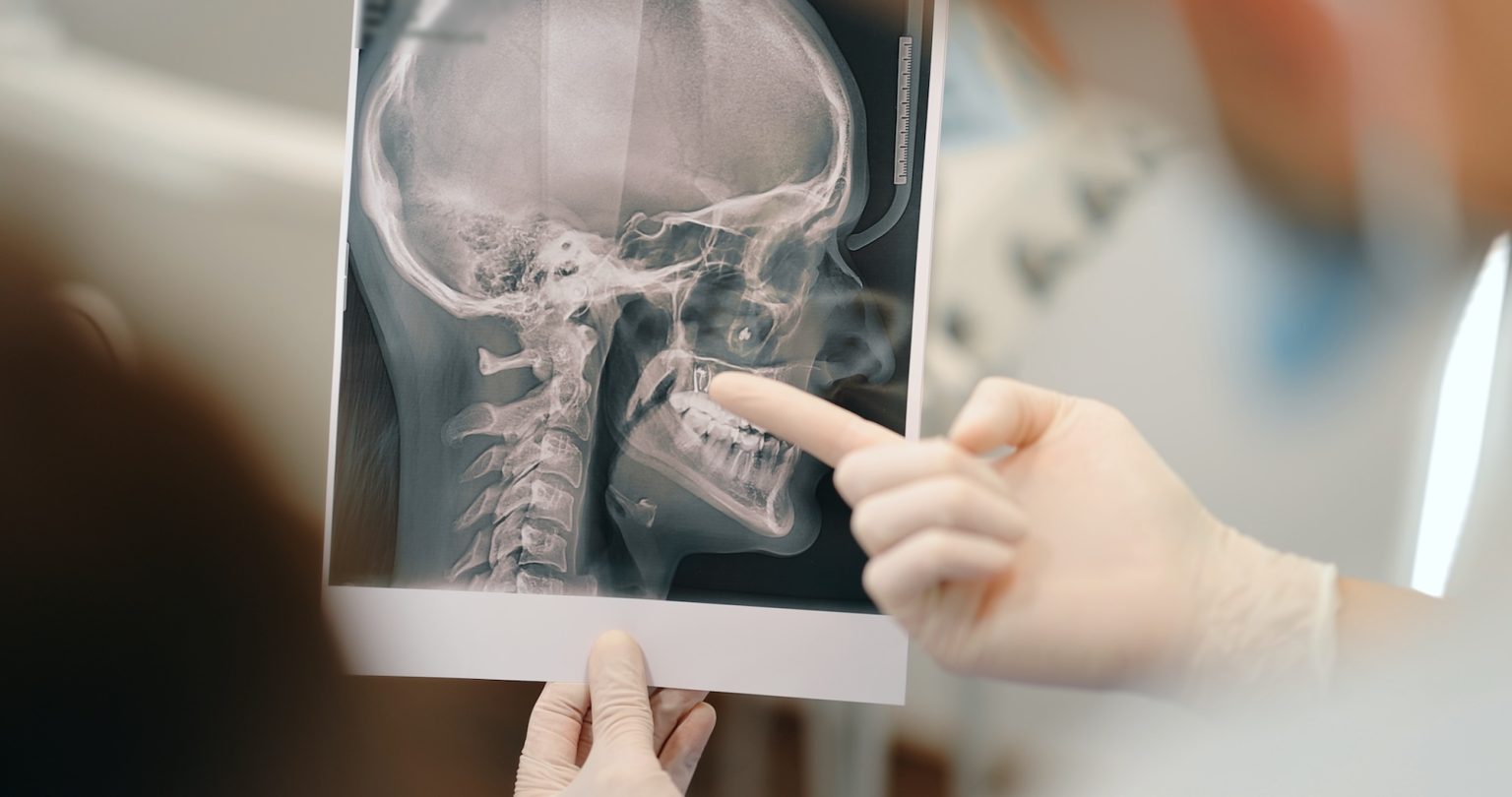 Sinus Exposure Repair » Oral Surgery in Houston, TX by Parkway Oral ...